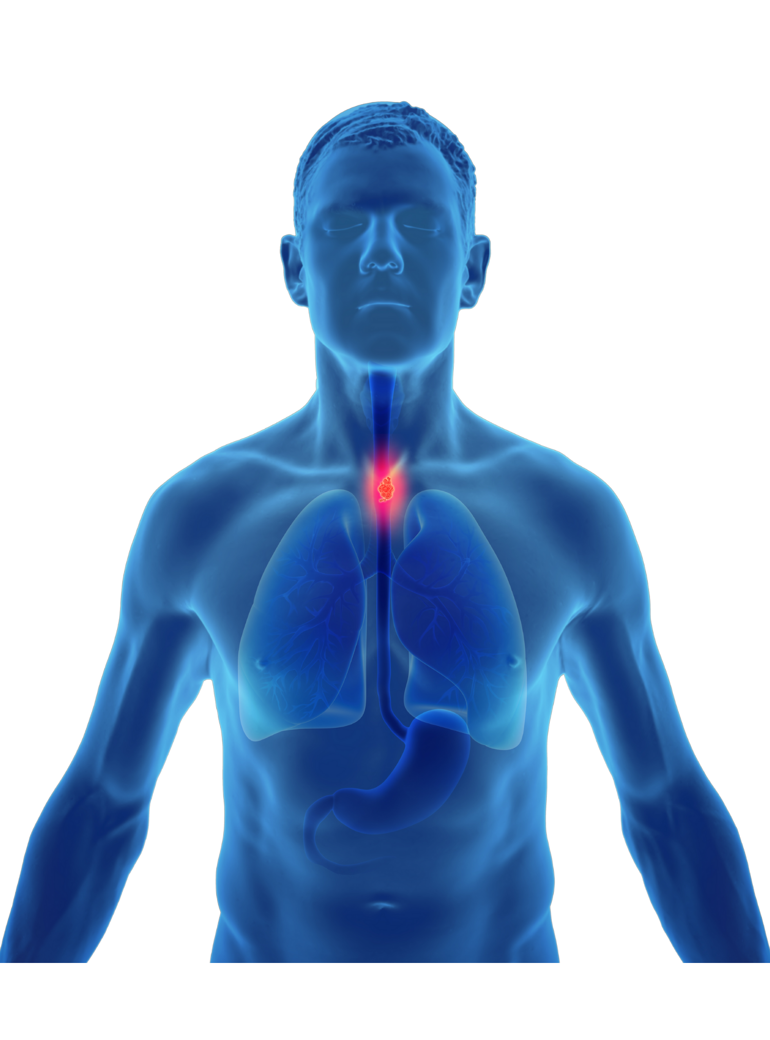 Cirugía De Esófago – Dr. Hernan González